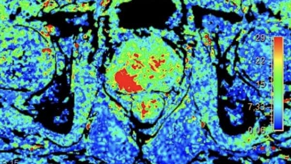 IRM prostate Paris 13 - Imagerie Médicale Paris 13