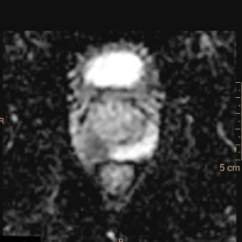 IRM prostate Paris 13 - Imagerie Médicale Paris 13